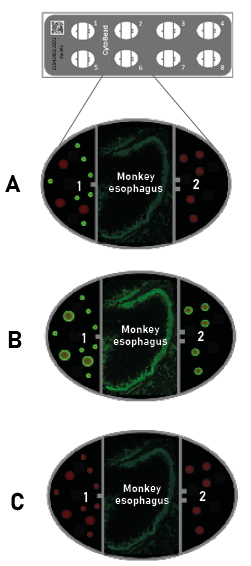 Selective IgA Deficiency Challenge in Celiac Disease Diagnostics
